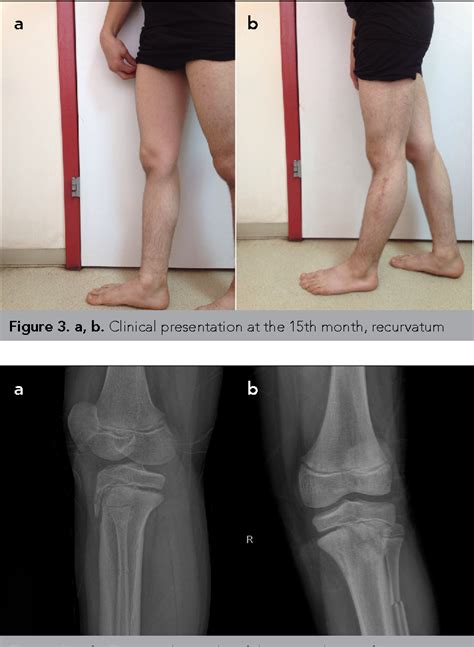 Figure 3 From Adolescent Proximal Tibia Physeal Injury Semantic Scholar