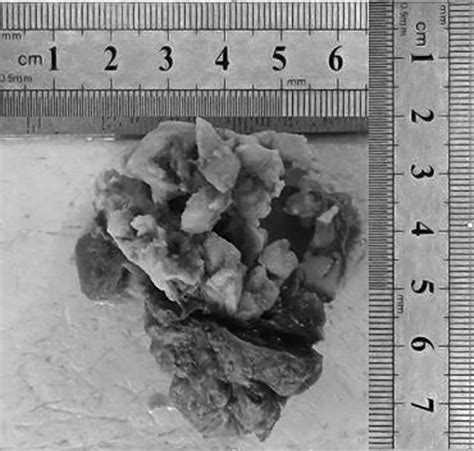 Parathyroid Gland And Right Thyroidal Lobe Download Scientific Diagram