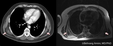 Roentgen Ray Reader Elastofibroma