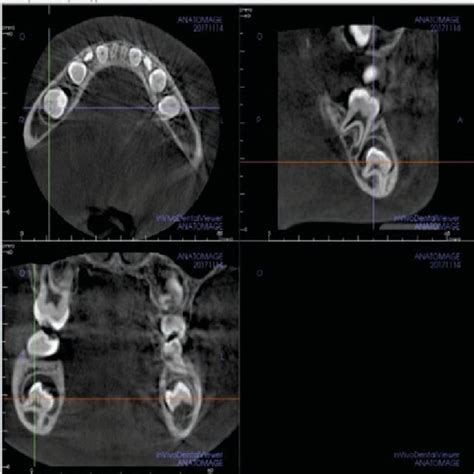 Panoramic Radiography Presence Of Impacted Tooth In The Jaw Region