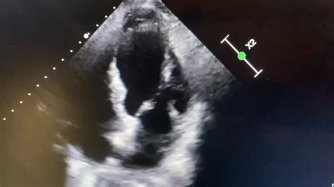 Hendre Van Rensburg On Linkedin Echo Echocardiography