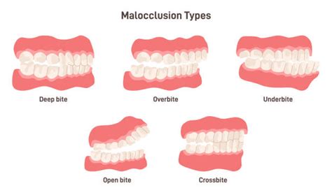 Malocclusion Types Causes Symptoms And Treatment Options