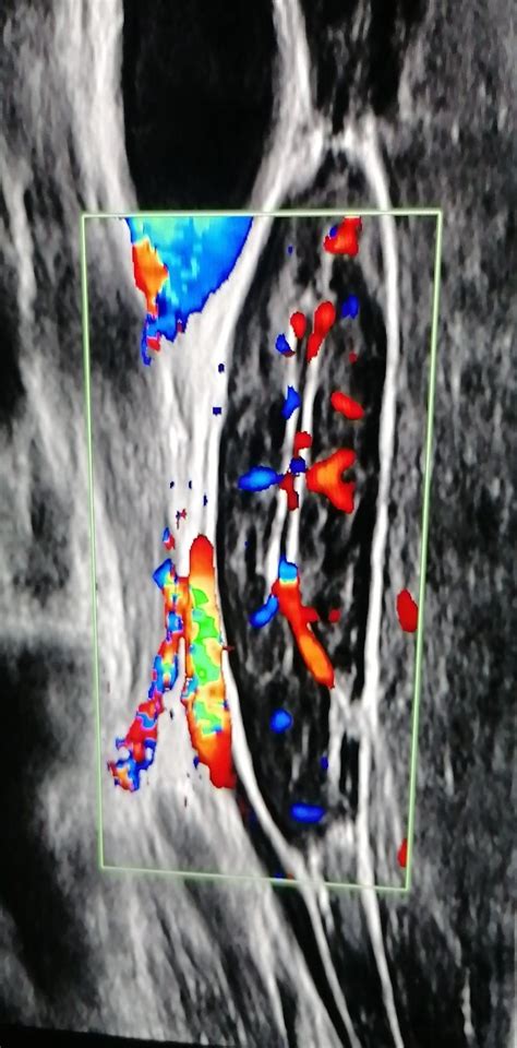 Sana Eisa On Linkedin Enlarged Cervical And Submandibular Lymphnodes Lymphadenities