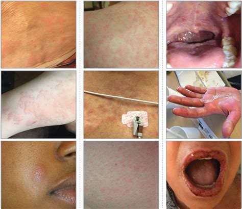 Reazione Allergica Alla Puntura Dape