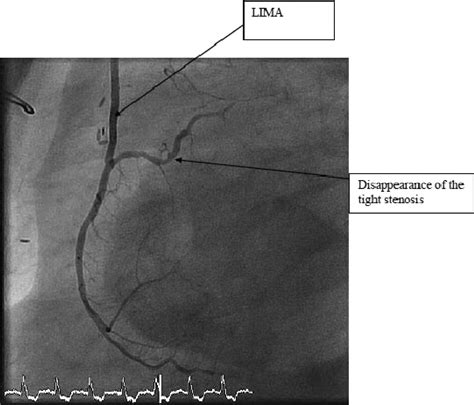 A Case Of Partial Congenital Absence Of Pericardium Revealed By Mri