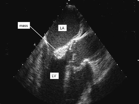 Caseous Calcification Of The Anterior Mitral Valve Annulus Presenting