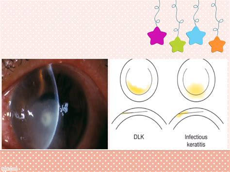 Diffuse Lamellar Keratitis Dlk Ppt Eye And Vision Conditions