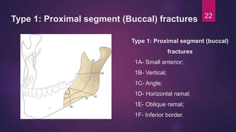 Journal Club Bad Splits In Bilateral Sagittal Split Osteotomy