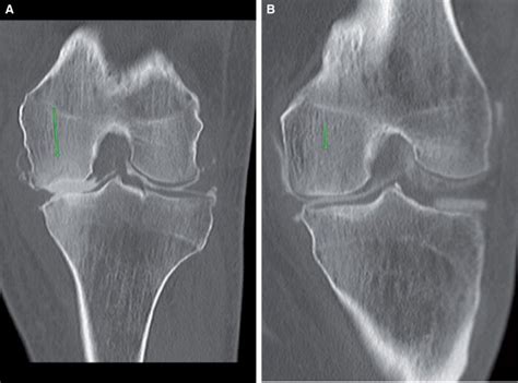 The Ct Knee Arthrogram Revisited Pmc