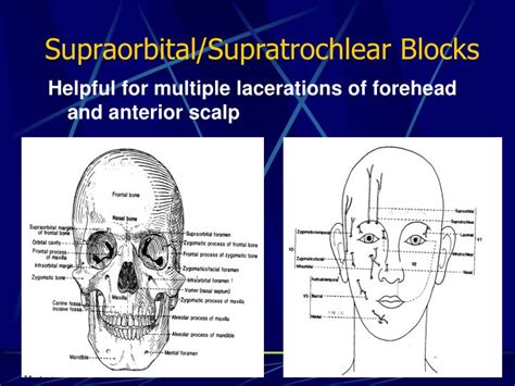 Supraorbital Nerve Block For Migraines