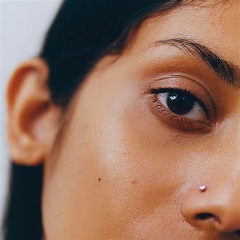 Understanding Dark Spots On The Face Allure Laser Skin And Aesthetic