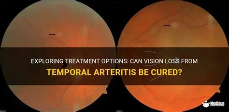 Exploring Treatment Options Can Vision Loss From Temporal Arteritis Be Cured Medshun
