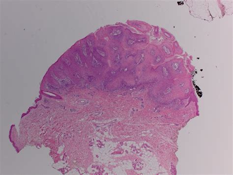 Reflectance Confocal Microscopy Of An Inverted Follicular Keratosis
