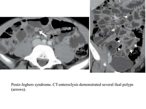 Ct Enteroclysis Pptx