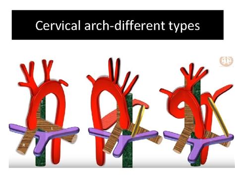 Aortic Arch Anomalies Dr Santhosh Narayanan Topic Outline