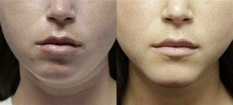 Chiseled Chin Surgery