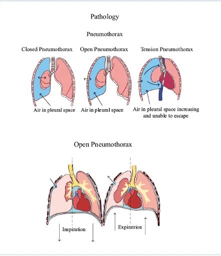 Thoracic Trauma Causes Symptoms Treatment Prevention