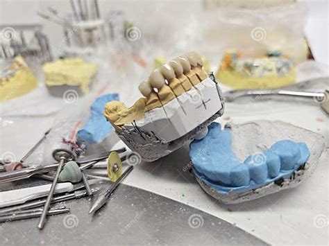 Ceramic Metal Bridge Prosthesis Is Demonstrated By A Doctor In A Dental