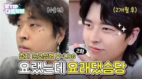 눈 코성형으로 이렇게 까지 바뀐다고 ｜ 남자 눈 코성형 브이로그 Youtube