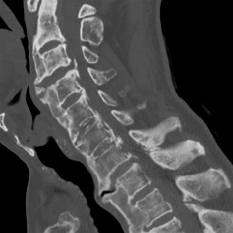 Pdf Surgical Treatment For Cervical Diffuse Idiopathic Skeletal