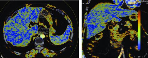 Fat Quantification Images Generated From The Dual Energy Computed Download Scientific Diagram
