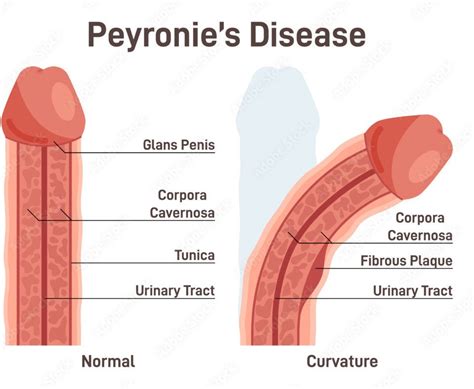 Will My Partner Feel The Curvature Caused By Peyronies Disease During Sex