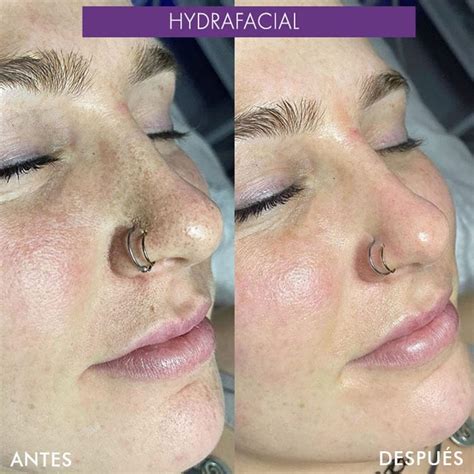 Nuevo Hydrafacial™ único En Tijuana Vida Wellness And Beauty