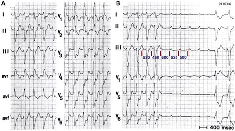 A 78 Year Old Man With Syncope Heart Rhythm