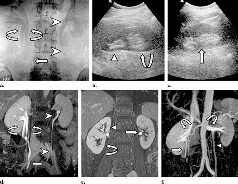 Intravenous Urographic Us And Mr Imaging Findings In Duplication Of