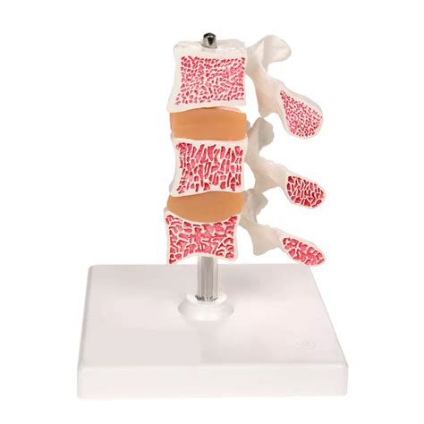 Buy A One Science Multicolor Pvc Vertebral Osteosis Model Aosbm34