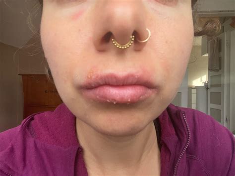 Has Anyone Found Their Nose Gets Congested When They Have A Pd Flare