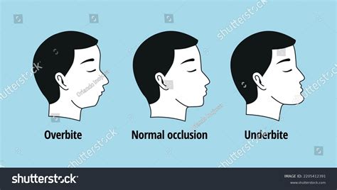 Tooth Problem Side View Man Misaligned Stock Vector Royalty Free