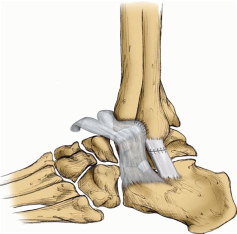 Syme Ankle Disarticulation Amputation Musculoskeletal Key