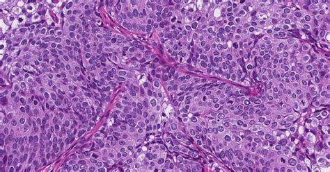Health Lines Cervical Squamous Cell Carcinoma Epidemiology Etiology Pathogenesis