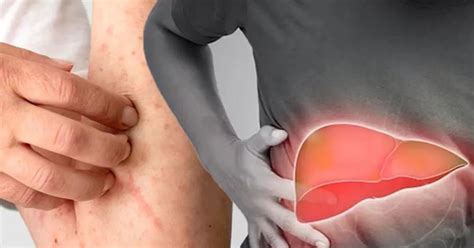 Skin Manifestations Silently Warn Of Liver Problems