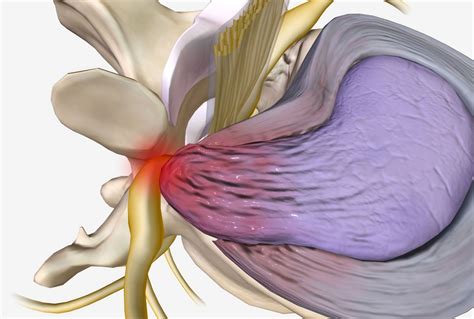 Herniated Disc Archives Spinal Backrack
