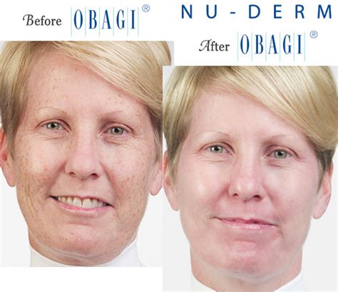 Obagi® Before And After Pictures Micki Ly M D Maui Dermatologist