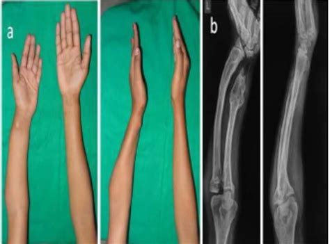 Pre Operative Forearm Deformity A Clinical Image Showing Ulnar Download Scientific Diagram