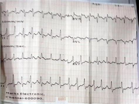 Ecg Digitalis Effect Mat Af Pptx