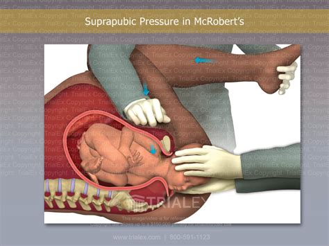 Suprapubic Pressure In Mcroberts Trialquest Inc