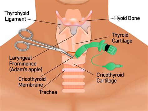 Cricothyrotomy Anatomy