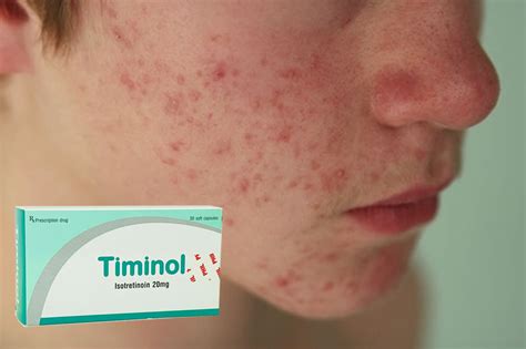 Thuốc Trị Mụn Trứng Cá Timinol Cách Sử Dụng Và Lưu ý Khi Dùng Thuốc