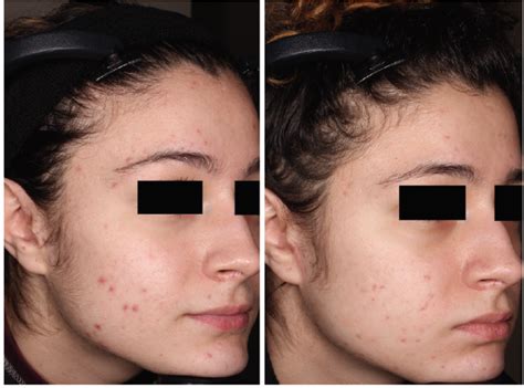 Tazarotene Lotion For Acne Emil A Tanghetti Md