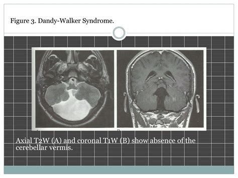 Ppt Brain Powerpoint Presentation Free Download Id4418887