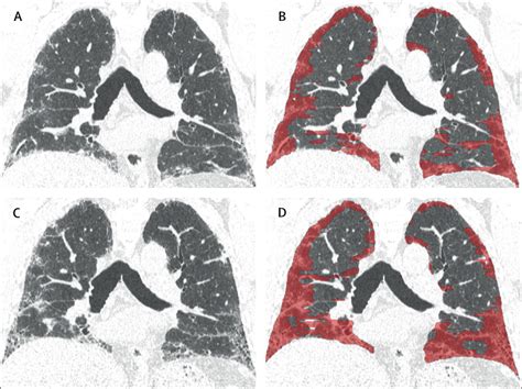 Imaging Research In Fibrotic Lung Disease Applying Deep Learning To