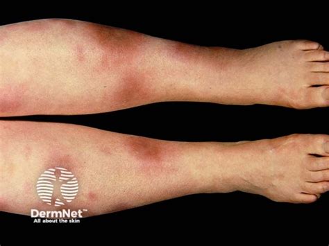Sarcoidosis Rash