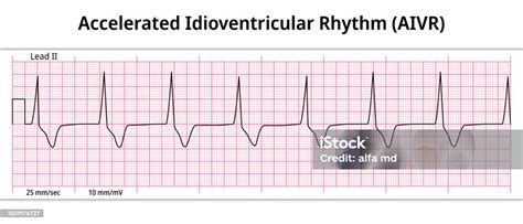 Ecg Accelerated Idioventricular Rhythm 8 Second Ecg Paper Stock