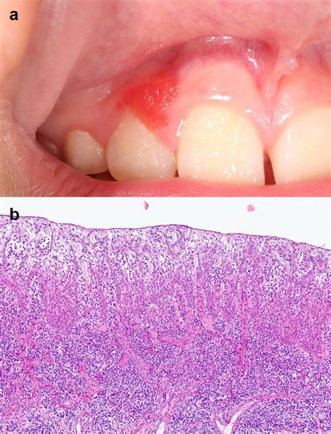 Squamous Papilloma On Gingiva