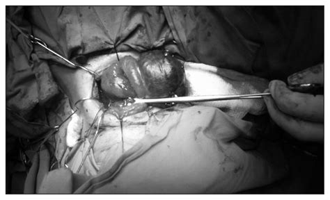 Thyroidectomy Draping Open Access Atlas Of Otolaryngology Head And Neck