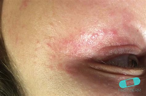 Rosacea Online Dermatology